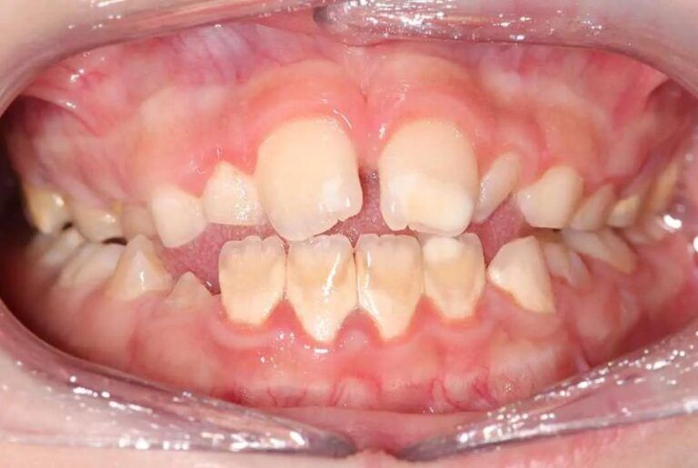 Openbite in a child | BOJ Paediatric Dentistry Barcelona