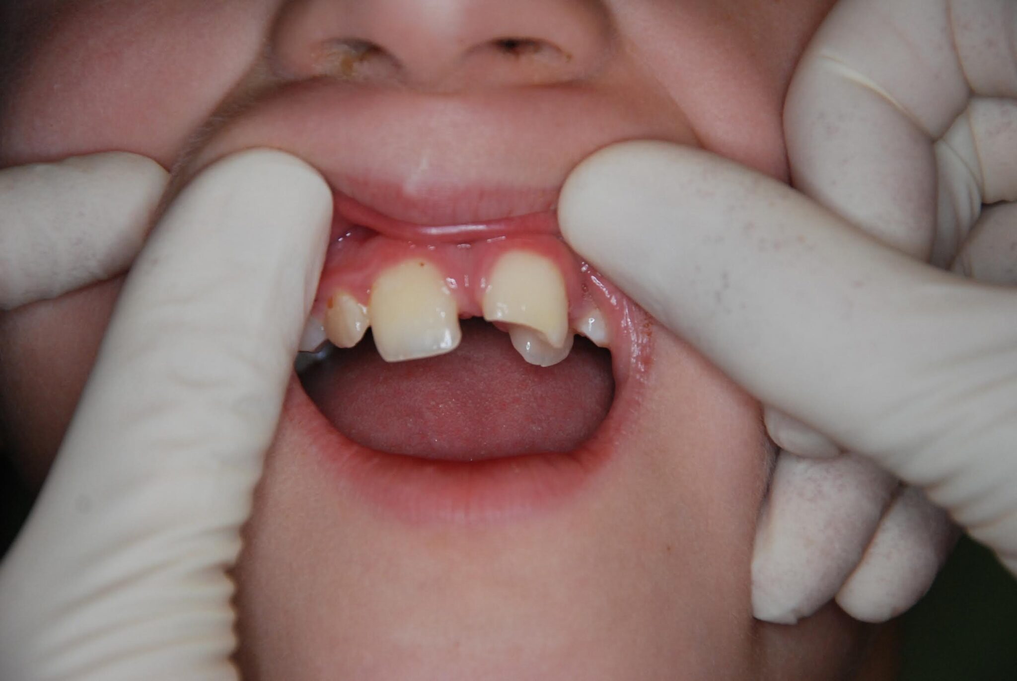 Incisor teeth | BOJ Pediatric Dentristry Clinic in Barcelona