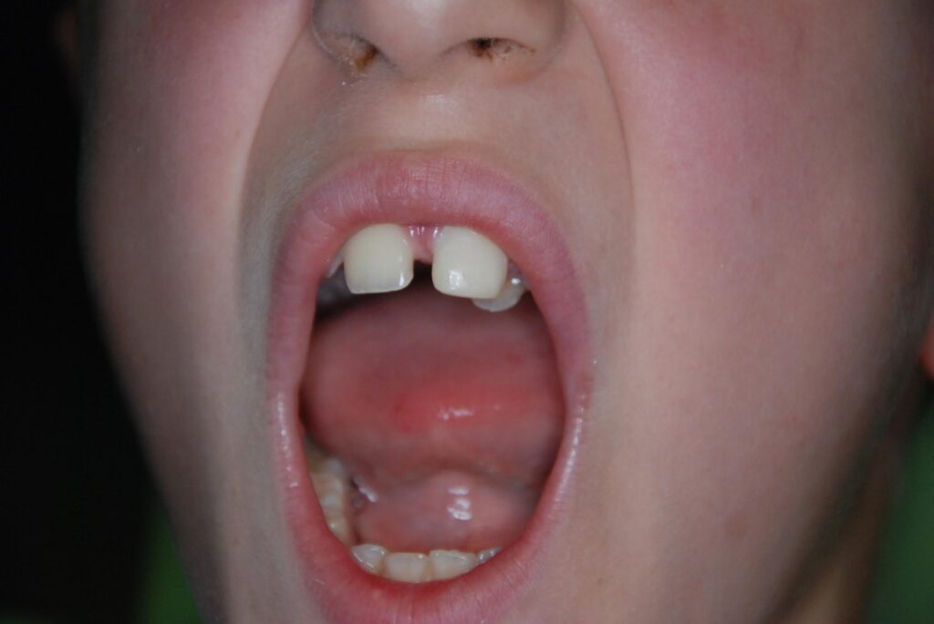 Incisor teeth | BOJ Pediatric Dentristry Clinic in Barcelona